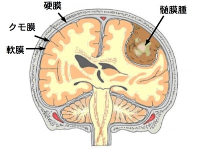 髄膜腫の症状診断治療 脳神経の病気 All About